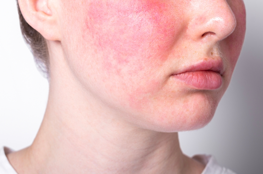 Behind The Redness Decoding Malar Rash Vs Rosacea Behind The Redness Decoding Malar Rash Vs Rosacea